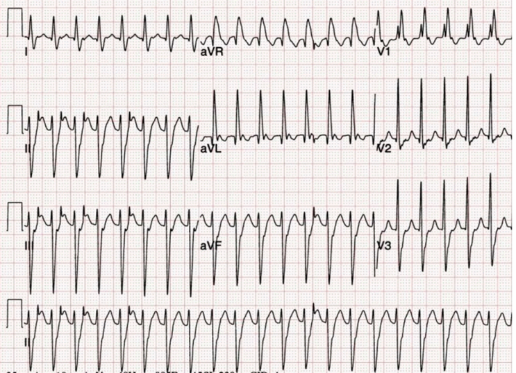 섬유속 심실빈맥 (Fascicular VT, fascicular ventricular tachycardia) 심전도 : 네이버 블로그
