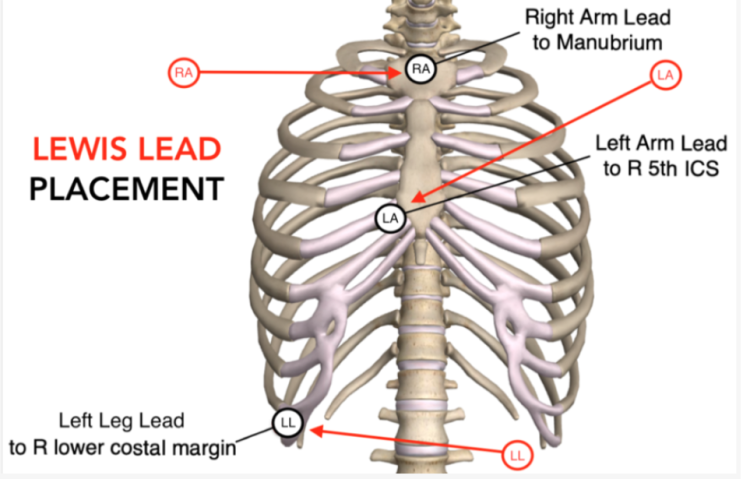 [심전도] Lewis lead : 네이버 블로그