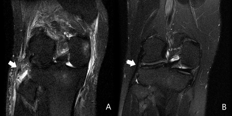 무릎 후외측인대군(PLC, posterolateral ligament complex) 혹은 외측측부인대(LCL, lateral ...