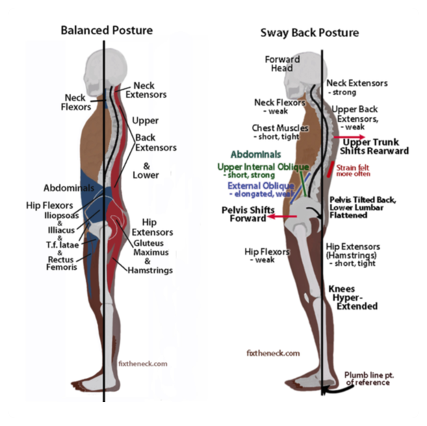 굽은등(sway back) : 네이버 블로그