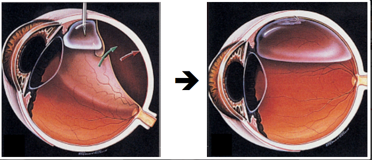 안과 공부, vitrectomy, gas injection : 네이버 블로그