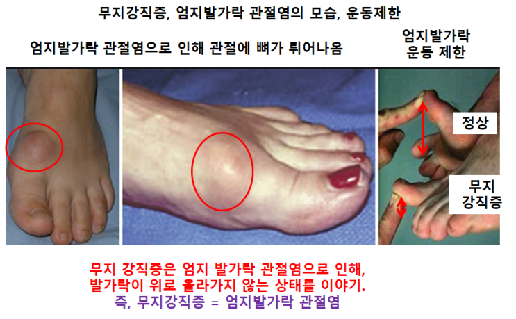 무지강직증 엄지발가락의 관절염 의 소개 및 비 수술적 치료 엄지 발가락이 아파요 엄지발가락이 위로 올라가지 않아요족부