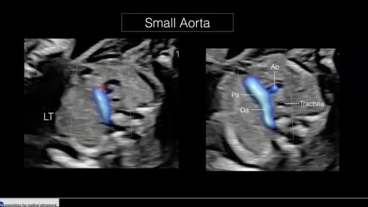 Q42.Fetal 3 vessel views/ 16번째 AIUM 합격 인증서와 태아 초음파 강의 요약 : 네이버 블로그