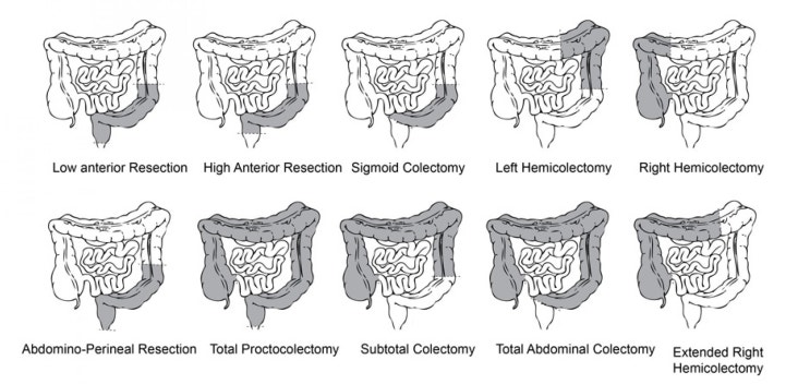 대장절제술(colectomy) : 대장암(colon cancer), 대장염(colitis) 등 대장질환의 위치에 따라 절제 ...