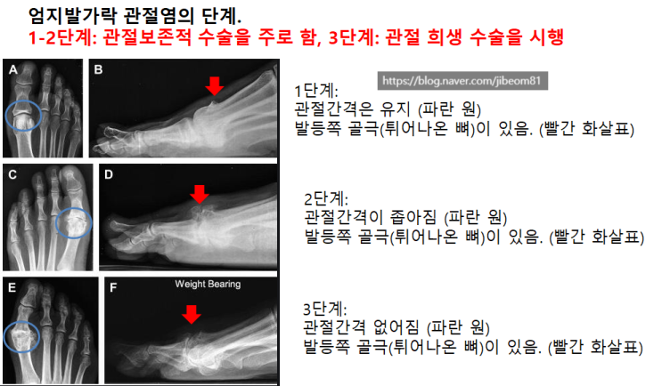 무지강직증 엄지발가락의 관절염의 수술적 치료 관절염의 정도에 따라 수술 방법이 달라진다구요 족부 정형외과 전문의 김지범