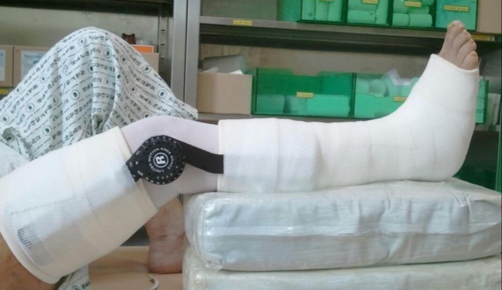 Long Leg Knee Brace Cast : 네이버 블로그