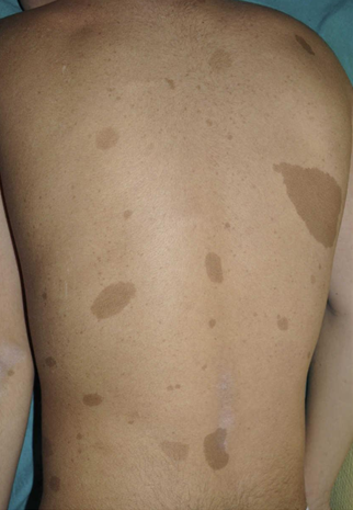 밀크커피색반점 (Café-au-lait macules) : 네이버 블로그