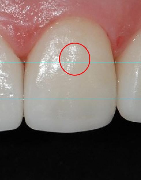 연세굿데이치과 기공세미나 PART 2. shade taking : 네이버 블로그