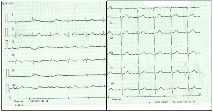 Prolonged QTc or Prolonged ST or Flat T wave with first degree AV block ...