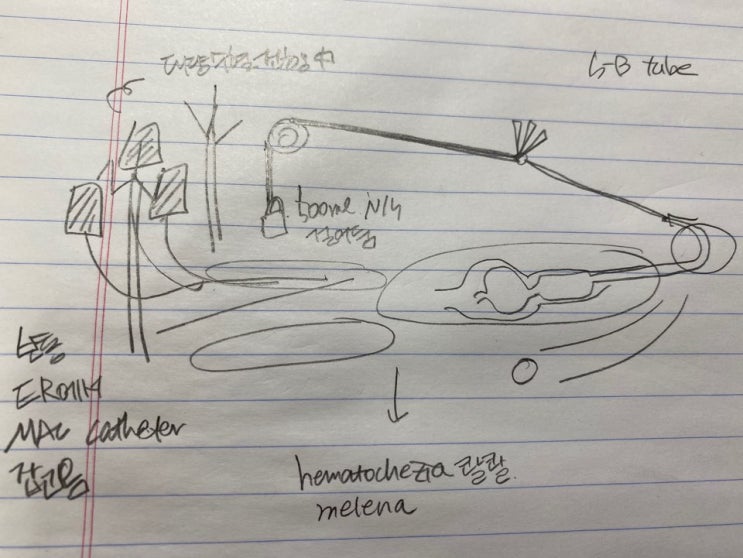 S-B tube(sengstaken-blakemore tube) : 네이버 블로그