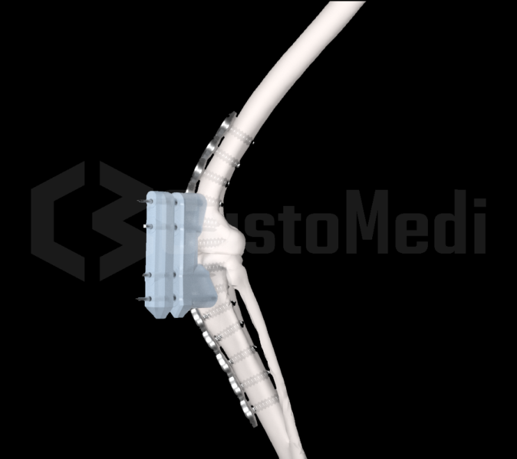 🐶 Customedi ServiceㅣDesign of the post-arthrodesis stifle bone model ...