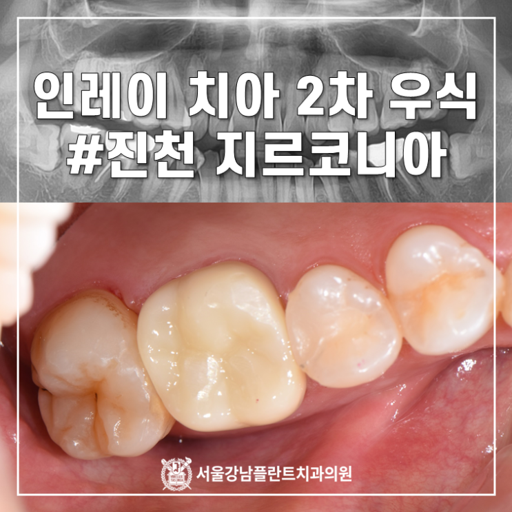 오래된 인레이 치아 통증 2차 우식 신경치료와 지르코니아크라운으로 네이버 블로그