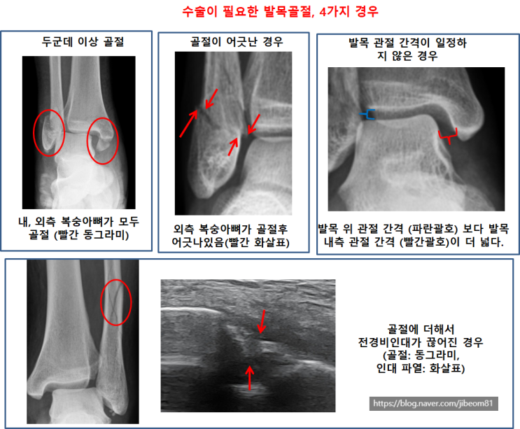 발목 비골 골절의 비수술 치료 사례 발목 외측 복숭아뼈가 부러졌어요 수술해야 된다는데 수술 안해도 되나요 족부 정형외과