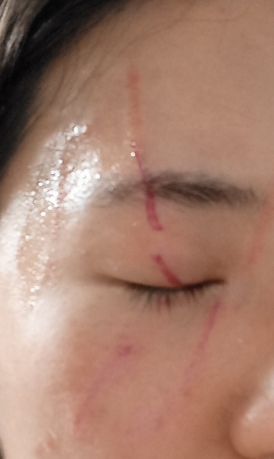 고양이한테 긁힌 후 : 네이버 블로그