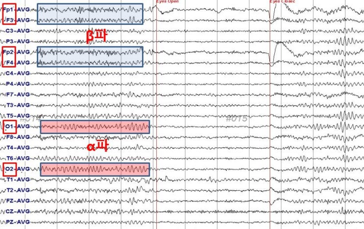 각성뇌파와 알파파-정상기본뇌파 : 네이버 블로그
