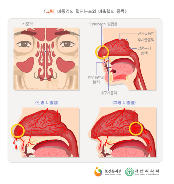 코피 자주 나는 아이 코피 나는 이유 코피 멈추는 법 해운대함소아한의원 네이버 블로그