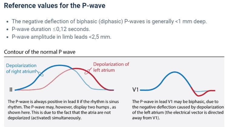 P-wave, P-mitrale & P-pulmonale : 네이버 블로그