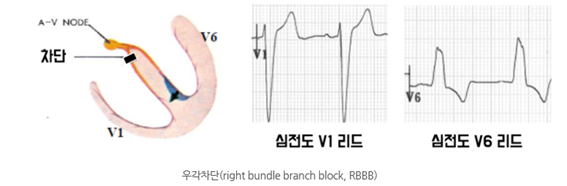 알기쉬운 RBBB, LBBB : 네이버 블로그