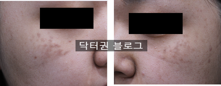 피코레이저 ABNOM (후천성 오타모양반점) 치료 사례 : 네이버 블로그