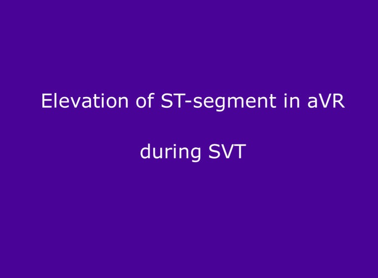 Rated-related aVR ST-segment elevation during SVT [EKG] : 네이버 블로그