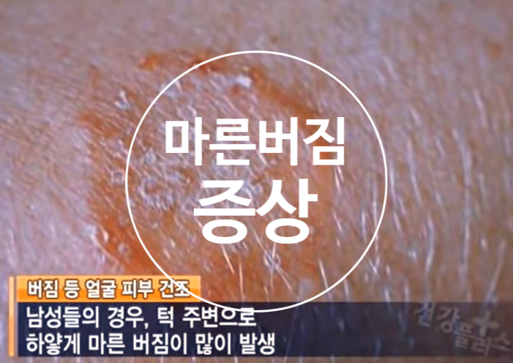 피부 마른버짐 건선 증상 예방 네이버 블로그