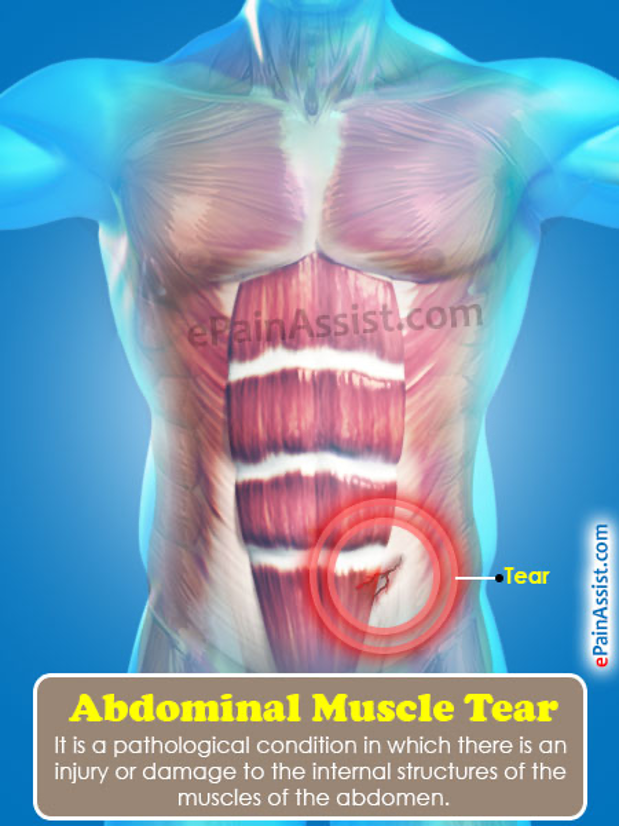 Abdominal muscle tear (복근 파열) : 네이버 블로그