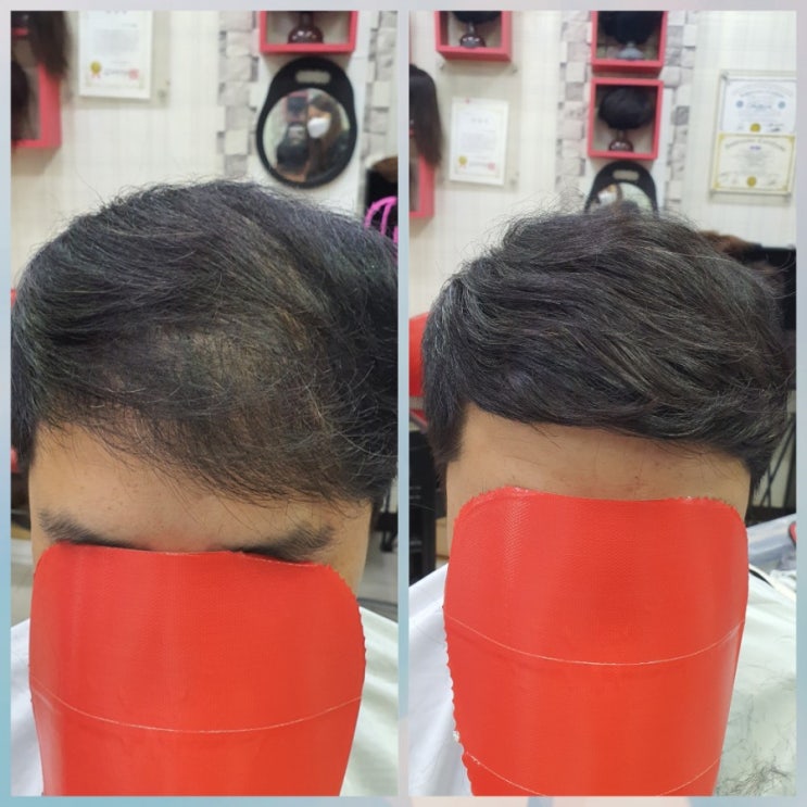 선택하세요 대전 남자 가발입니까 대전 남자 붙임머리 대전증모술입니까 네이버 블로그