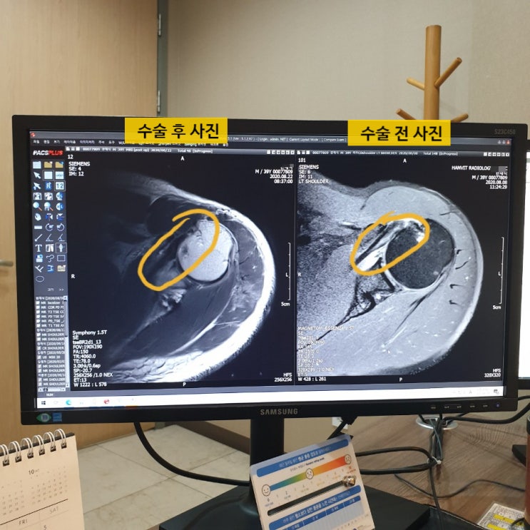 어깨 회전근개 파열 수술 치료기5어깨보호대 제거 초음파검사 재활운동 준비 네이버 블로그