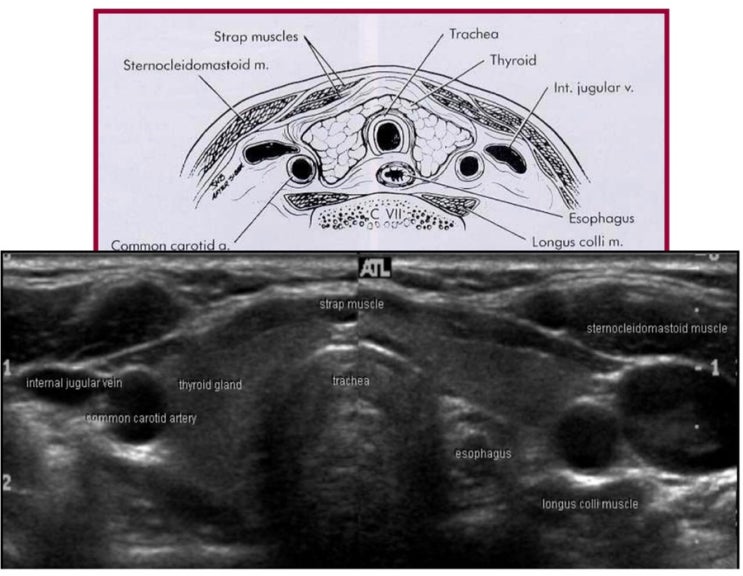 Thyroid sono : 네이버 블로그