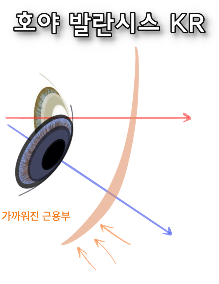양안 백내장 수술 후 빛번짐과 눈부심을 적응하기 쉬운 Hoya 발란시스 Kr 누진 다초점 변색 안경으로 해결 네이버 블로그