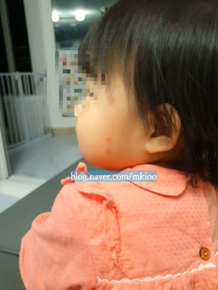 모기 물린 곳이 퉁퉁 붓는 모기 알레르기 스키터 증후군 대처방법들 Feat에스로반 연고 처방 네이버 블로그