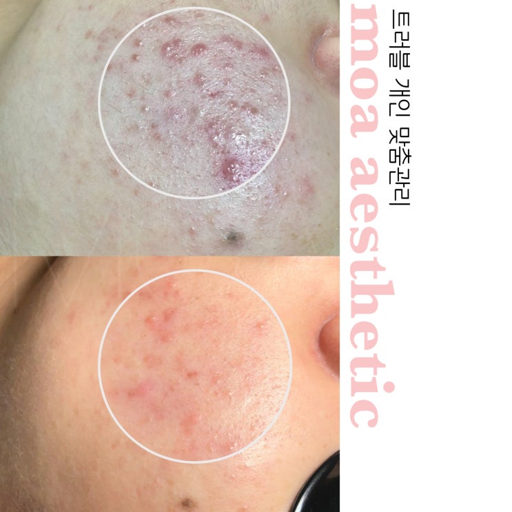 수원피부관리 인계동피부관리 모아에스테틱 여드름압출 피지압출 좁쌀여드름 홍조피부 필링관리 필링 리페어필 더마이지젯 네이버 블로그