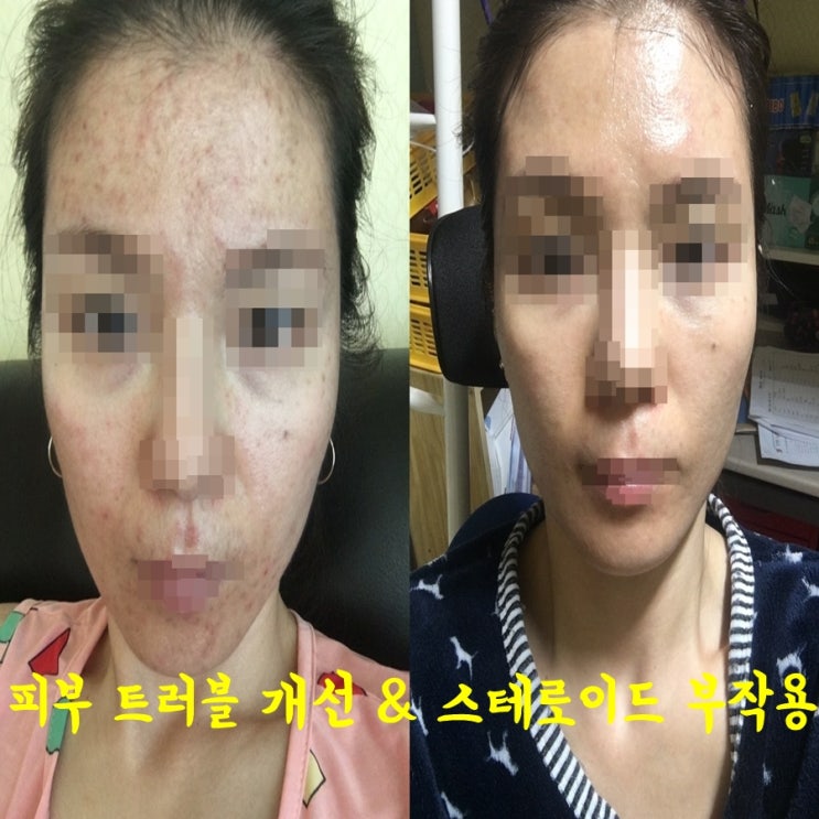 예작화장품 피부 전체 트러블 And 스테로이드 약 부작용 And 트러블 개선 And 지루성 피부염 네이버 블로그