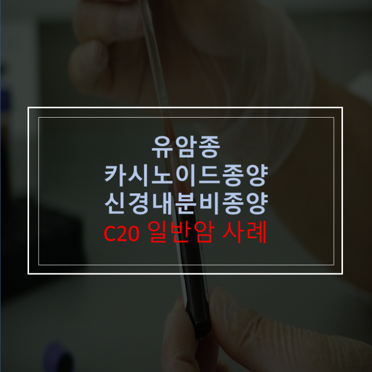 직장유암종 악성신생물 C20 지급 판례Ⅰ카르시노이드종양D37.5C20Ⅰ직장 유암종경계성종양D37.5C20Ⅰ신경내분비종양D37.5C20Ⅰ한국표준질병사인분류Ⅰ : 네이버 블로그