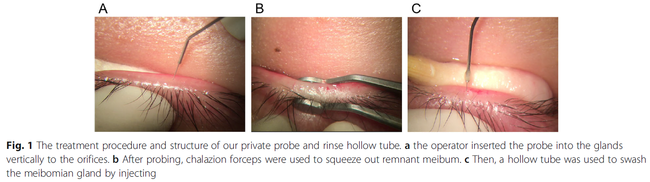 마이봄샘프루빙(개구부뚫기?) meibomian gland probing 의 효과 : 네이버 블로그