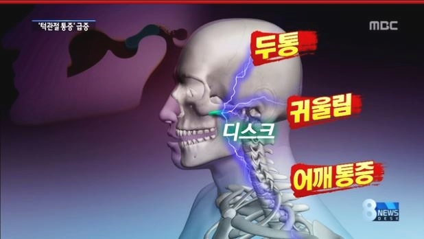 광주턱관절 턱에서 ‘딱딱 소리가 난다 턱관절 통증 장애 원인 및 치료 방법 첨단한방병원 네이버 블로그