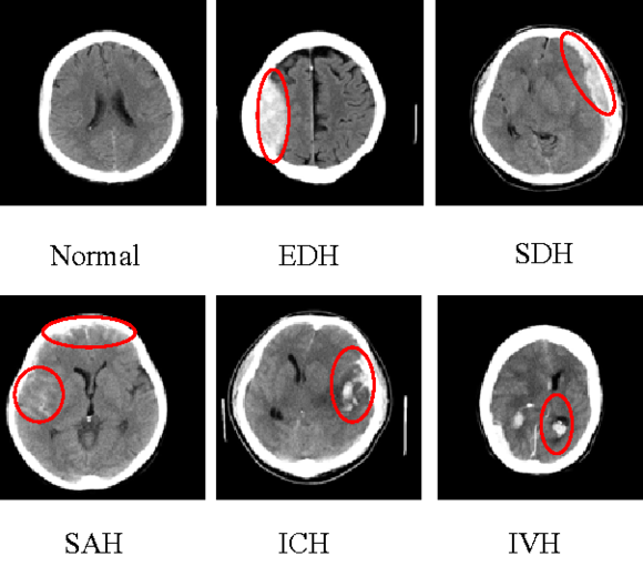 ICH(intra-cranial hemorrhage) : 네이버 블로그
