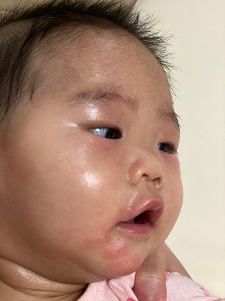 질병 아기 침독 아기 초기 아토피 아기 접촉성 피부염 이유식 알러지 어떤 크림연고 쓰시나요 네이버 블로그
