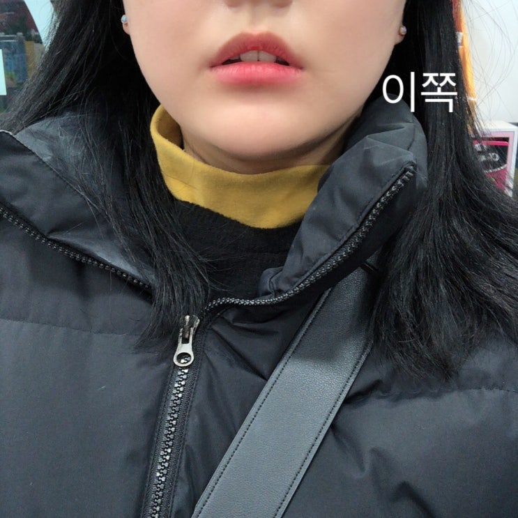 어금니 염증 충치 발치 사랑니 실밥제거 후기붓기 통증 비용 임플란트 과정2탄 네이버 블로그