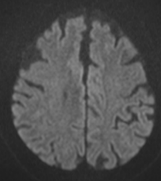 Brain MRI : 어지러움 dizziness : 네이버 블로그