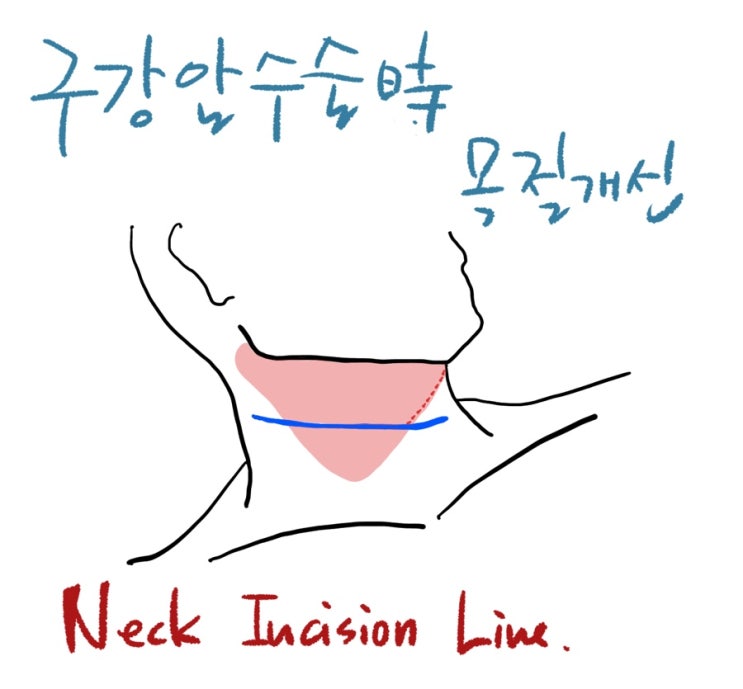 구강암 수술시 목절개선 Neck Incision : 네이버 블로그
