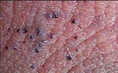 음낭 혈관각화종, 피각혈관종 (angiokeratoma of fordyce) : 네이버 블로그