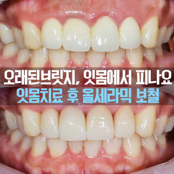 대구 심미보철치과 E28치과 오래된 앞니브릿지 잇몸에서 피나요 잇몸치료 후 올세라믹 크라운 네이버 블로그