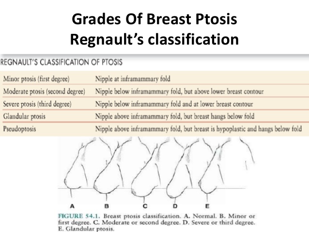 처진 가슴도 가슴확대 수술로 리프팅될까? : 네이버 블로그
