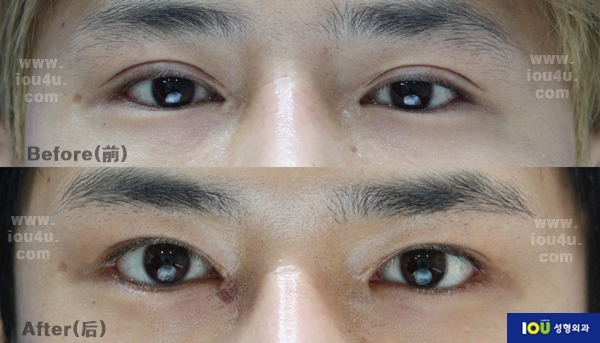 쌍꺼풀재수술(눈재수술):높은쌍꺼풀,밑트임 High fold,Slanted eye lowering 双眼皮过高 修复,降低眼角 ...