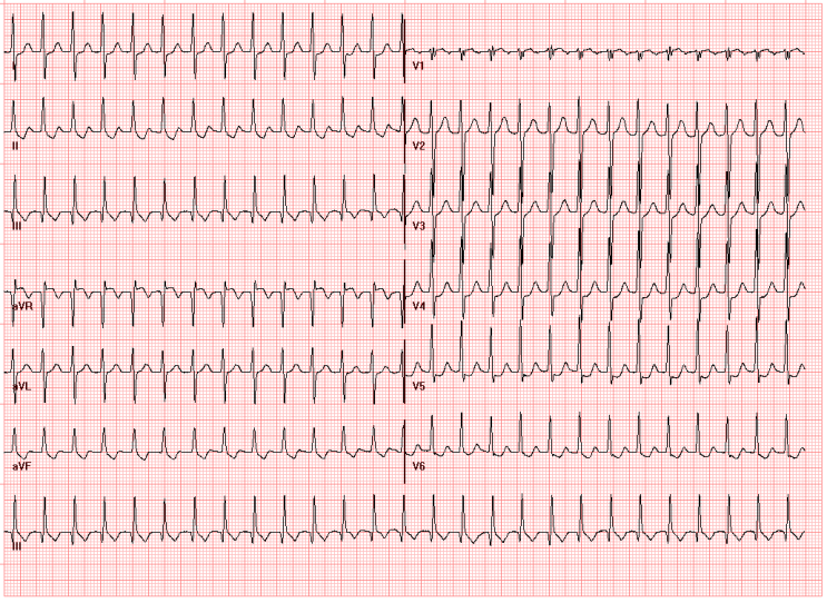 PSVT, 3 가지 경우 ① ② ③ : 네이버 블로그
