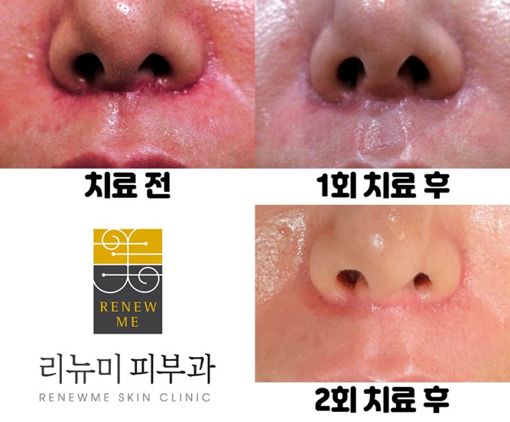 리뉴미피부과 Dna 흉터재생술 리뉴미피부과 화곡점 치료 사례 네이버 블로그