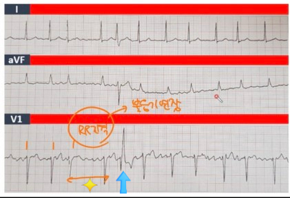 2 Atrial foci(AFL, Af, MAT) : 네이버 블로그