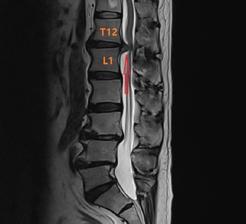 요추 1번 신경 손상시 통증부위 ( T12/L1 사이에 디스크 탈출증이 발생한 경우) : 네이버 블로그