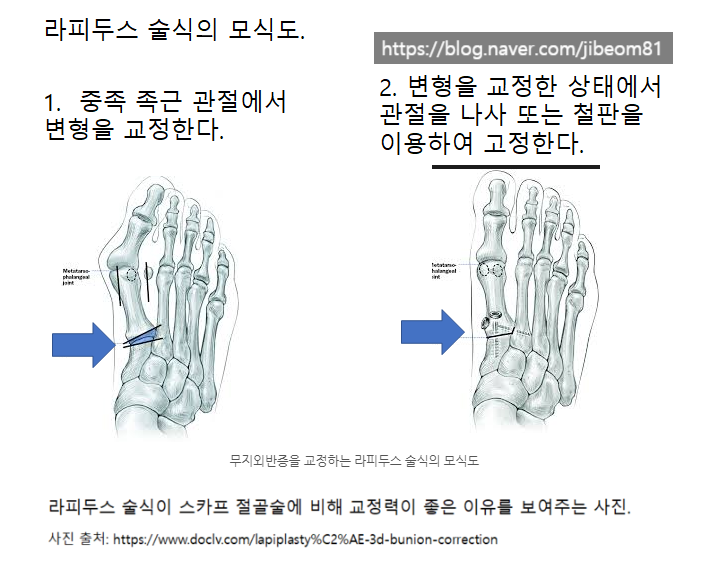 두번째 발가락이 구부러진 무지외반증의 치료 두번째 발가락이 신발에 닿고 발바닥 쪽이 아파요 두번째 발가락 탈구의 수술